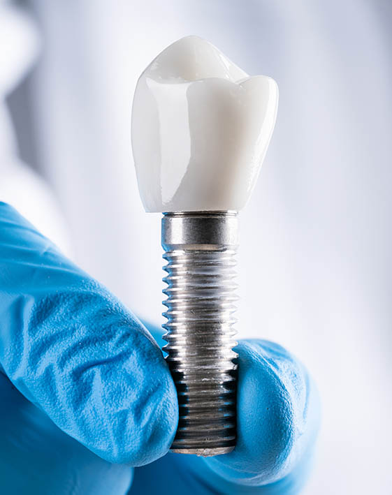 İmplant Nedir? İmplant Nasıl Yapılır? - ASMED Diş